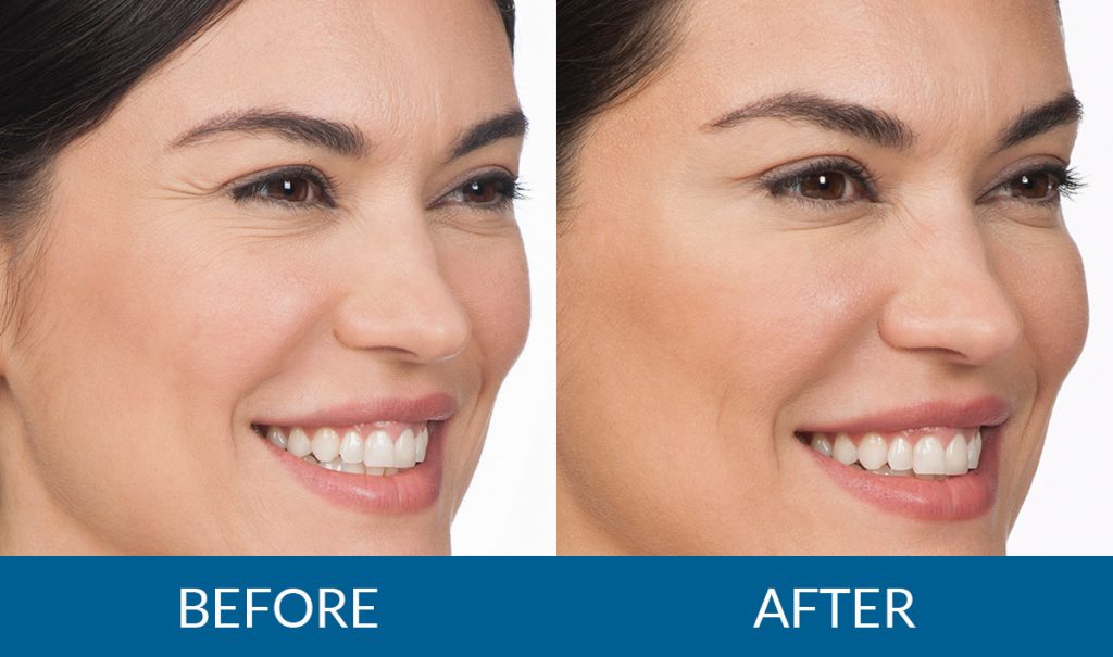 Neurotoxin Treatment | Dr. Durland's Simple Wellness | Wellness made SIMPLE